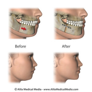 Surgical Orthodontics in Colorado Springs, CO | Bailey Orthodontics